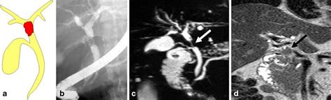 A Drawing Illustrates Bismuth Corlette Type I Tumor That Is Confined Download Scientific