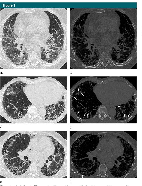 Table 1 From Diffuse Pulmonary Ossification In Fibrosing Interstitial Lung Diseases Prevalence