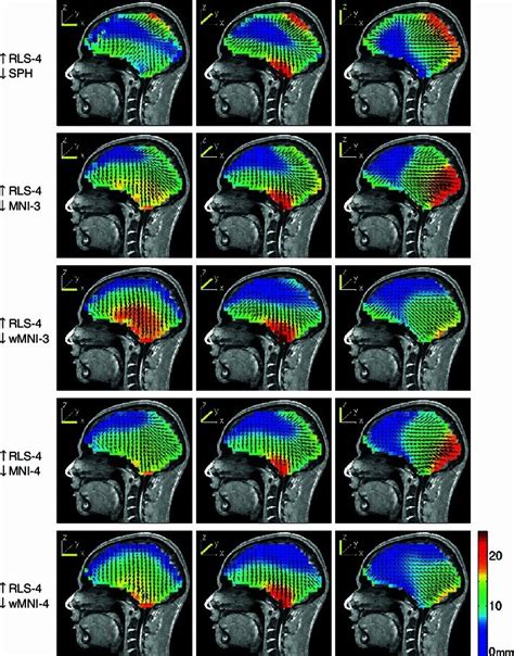 Equivalent Dipole Source Localization Error Directions Arrows And Download Scientific Diagram