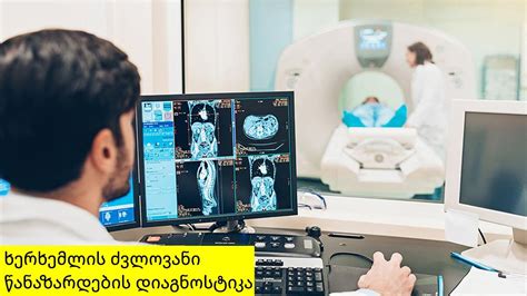 ხერხემლის ძვლოვანი წანაზარდების დიაგნოსტიკა Youtube