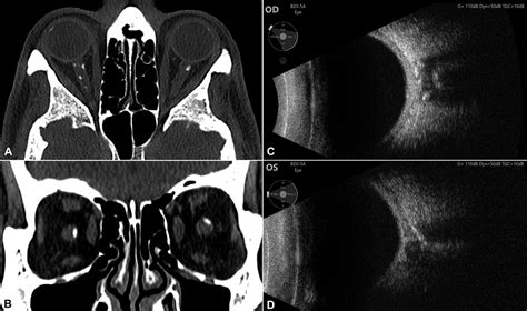 Bilateral Idiopathic Dural Optic Nerve Sheath Calcification Journal Of Neuro Ophthalmology