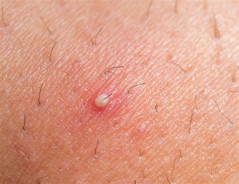 Ingrown Hair 5 Best Ways To Deal With It