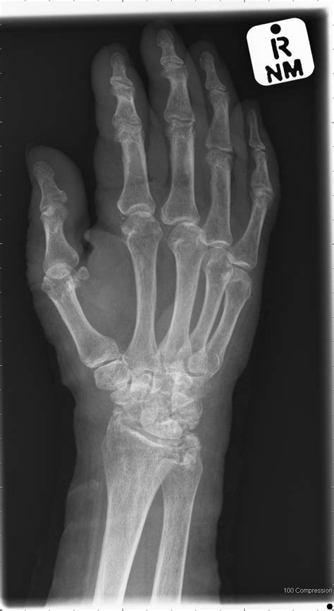 Calcium Pyrophosphate Deposition Disease Cppd Of The Elbow And Wrist Image Calcium Pyrophosphate Deposition Disease Cppd Of The Elbow And Wrist Image