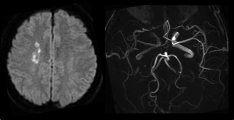 Figure 1 From A Case Of Intracerebral Hemorrhage Due To Cerebral