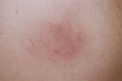 Small Area Of Hyperpigmentation Over The Patients Back Download Scientific Diagram