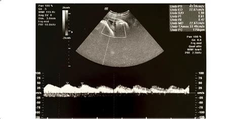 Umbilical Artery Pulsatility Index Download Scientific Diagram