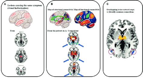 Using The Human Brain Connectome To Localize Symptoms 27 Download