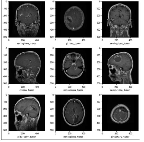 基于efficientnet的脑肿瘤分类模型 Acc 092 知乎