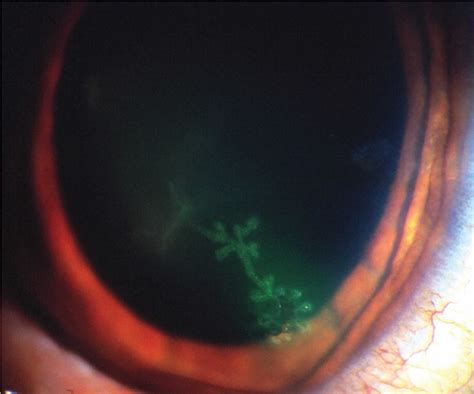 Herpes Causes Signs Symptoms Diagnosis Treatment And Prognosis