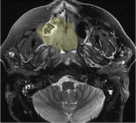 Mri Transverse Section Demonstrating Adenoid Cystic Carcinoma Of The Download Scientific