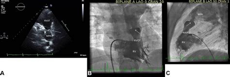 Pulmonary Valve Stenosis In The Adult Patient Pathophysiology