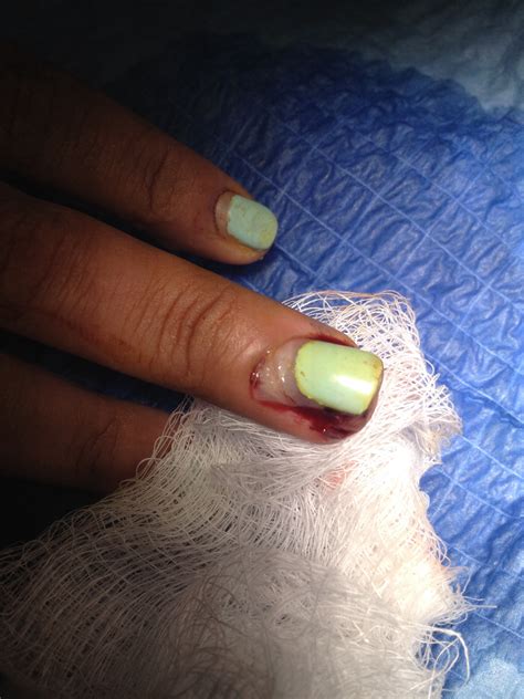 In Patients With Partial Nail Avulsion With Preserved Nail Structure And Without Laceration Or