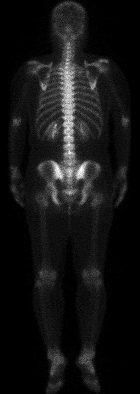 Spect Bone Scan