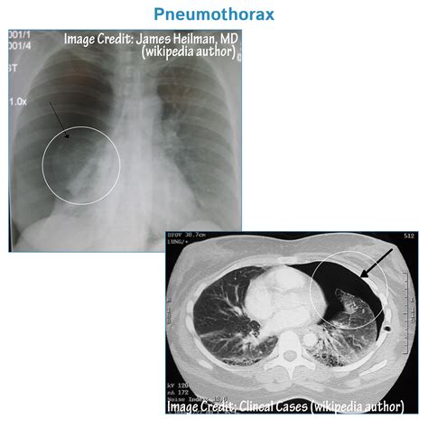 Clinical Pathology Glossary Pneumothorax Ditki Medical And Biological Sciences