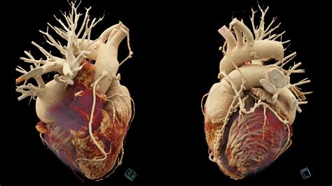 Sextuple Coronary Bypasses Siemens Healthineers