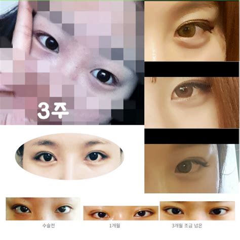앞트임 뒤트임 눈 커지는 정도 후기 가격