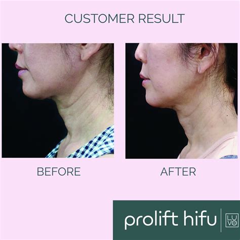 Facial Tightening For Non Surgical Face Lift Hifu Treatments