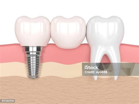 임 플 란 트 치과 외팔보 다리와의 3d 렌더링 3차원 형태에 대한 스톡 사진 및 기타 이미지 3차원 형태 건강관리와 의술 관교의치 Istock