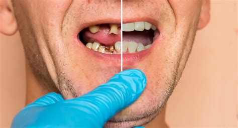 Bone Loss And Gum Disease In Monroe Ct Dr Richard Amato