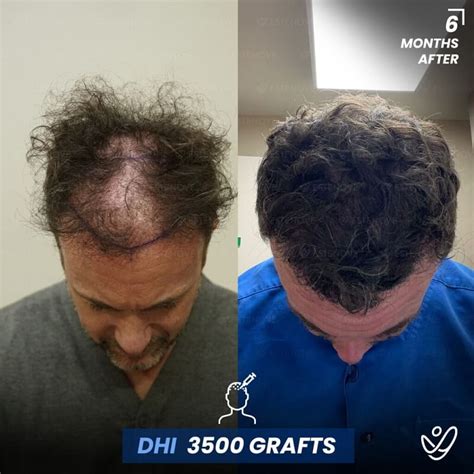 Dht And Hair Loss Causes Treatments And Solutions Estenove