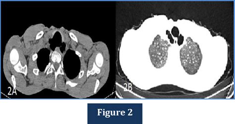 Figure 2 From Mounier Kuhn Syndrome A Rare Cause Of Bron Chiectasis