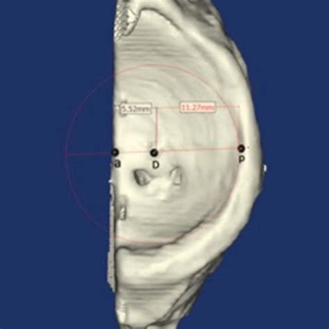 3d Reconstructed Ct Image Of The Left Glenoid With 25 Defect Best Fit Download Scientific