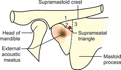 Suprameatal Triangle