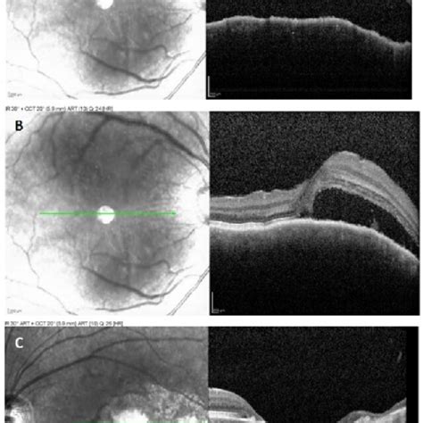 Oct Imaging Of The Macula At Presentation In A B The Right Eye Download Scientific Diagram