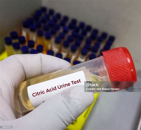 Urine Sample For Citric Acid Urine Test Used To Diagnose Renal Tubular Acidosis And Evaluate