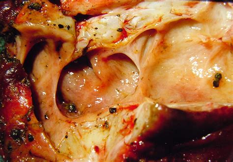 Cholangiohepatitis Surgery Photos