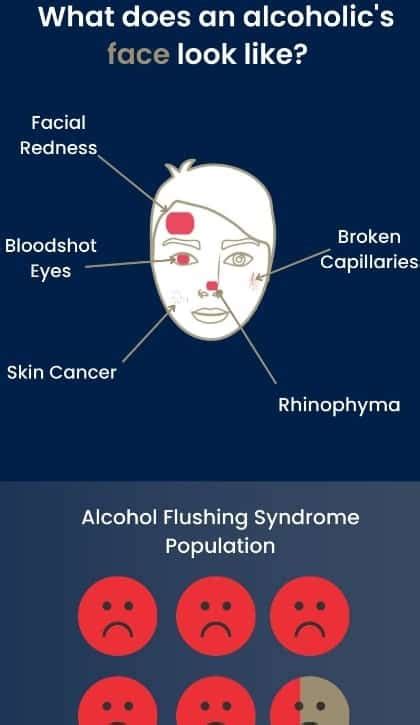 Alcoholic Face Swelling