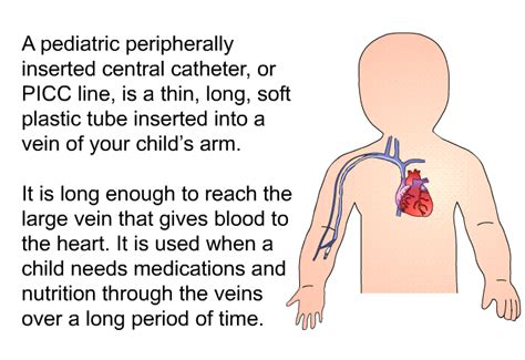 Peripherally Inserted Central Catheter Picc Line Pediatrics