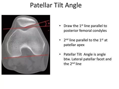 Recurrent Patellar Dislocation Ppt