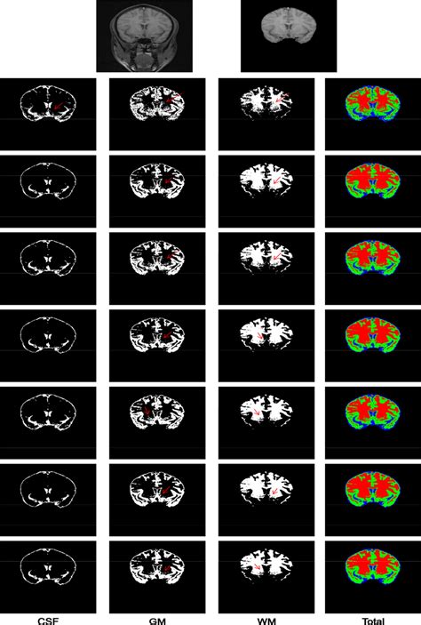 Segmentation Results Of A Real Brain Mr Image Of Our Local Data Set By