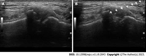 Manubriosternal Joint