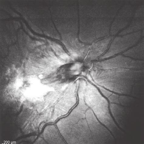 Classification Of Epiretinal Membranes Download Scientific Diagram