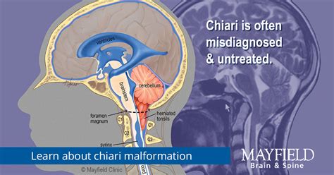 Chiari Chiari Malformation