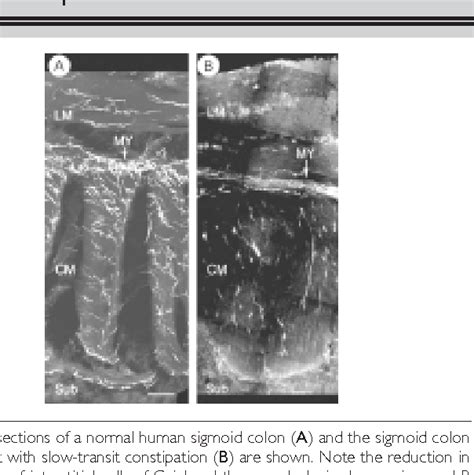 Figure 2 From Pathophysiology Of Chronic Constipation And Ibs