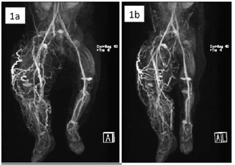 Parkes Weber Syndrome A Rare Vascular Malformation Imaging And The