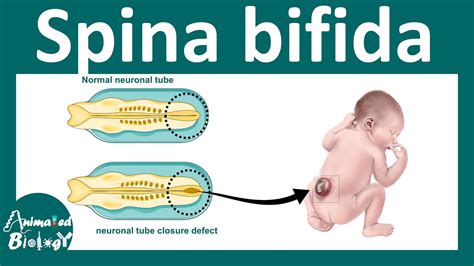 Spina Bifida Meningomyelocele
