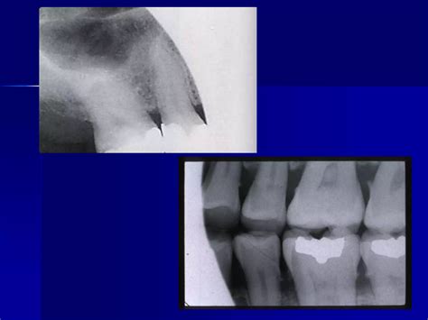 Radiographic Errors And Artifacts Pptx