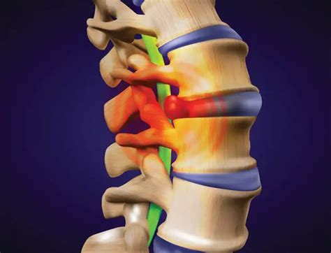 Spinal Discectomy Surgery
