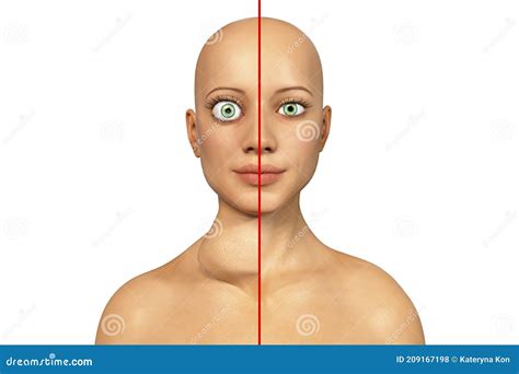 Toxic Diffuse Goiter Stock Illustration 104687950