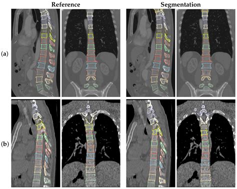 lumbar and thoracic vertebrae segmentation in ct scans using a 3d multi object localization and