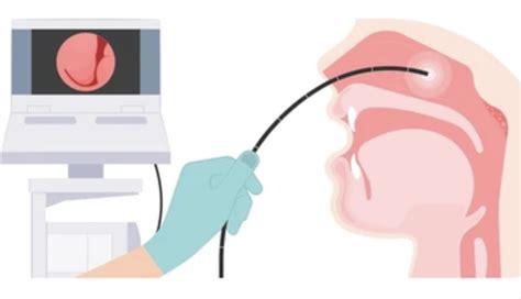 Patulous Eustachian Tube Symptoms Diagnosis And Treatment Explained