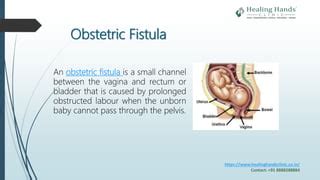Obstetric Fistula Causes Symptoms And Treatment Pptx