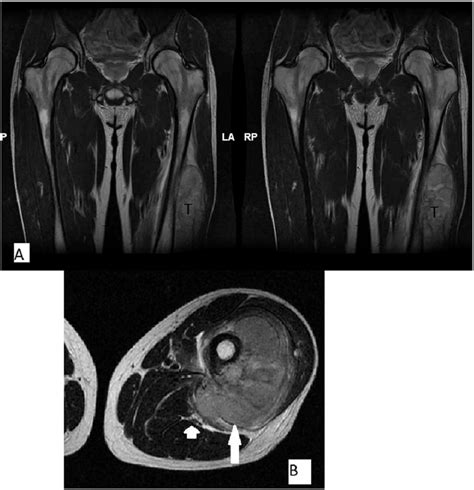 Consecutive T2 Weighted Coronal Mri Images A And Axial T2 Weighted
