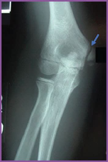 Overuse Injuries Musculoskeletal Key