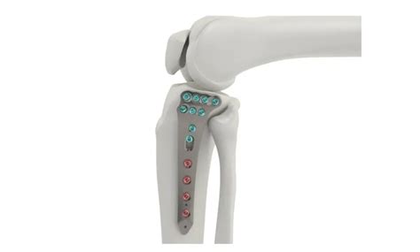 Tyber Medical Acquires Fda Clearance For Proximal Tibia Plating System