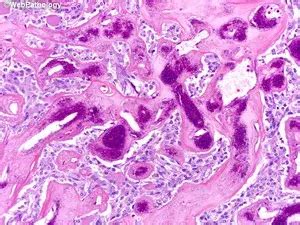 Medullary Carcinoma